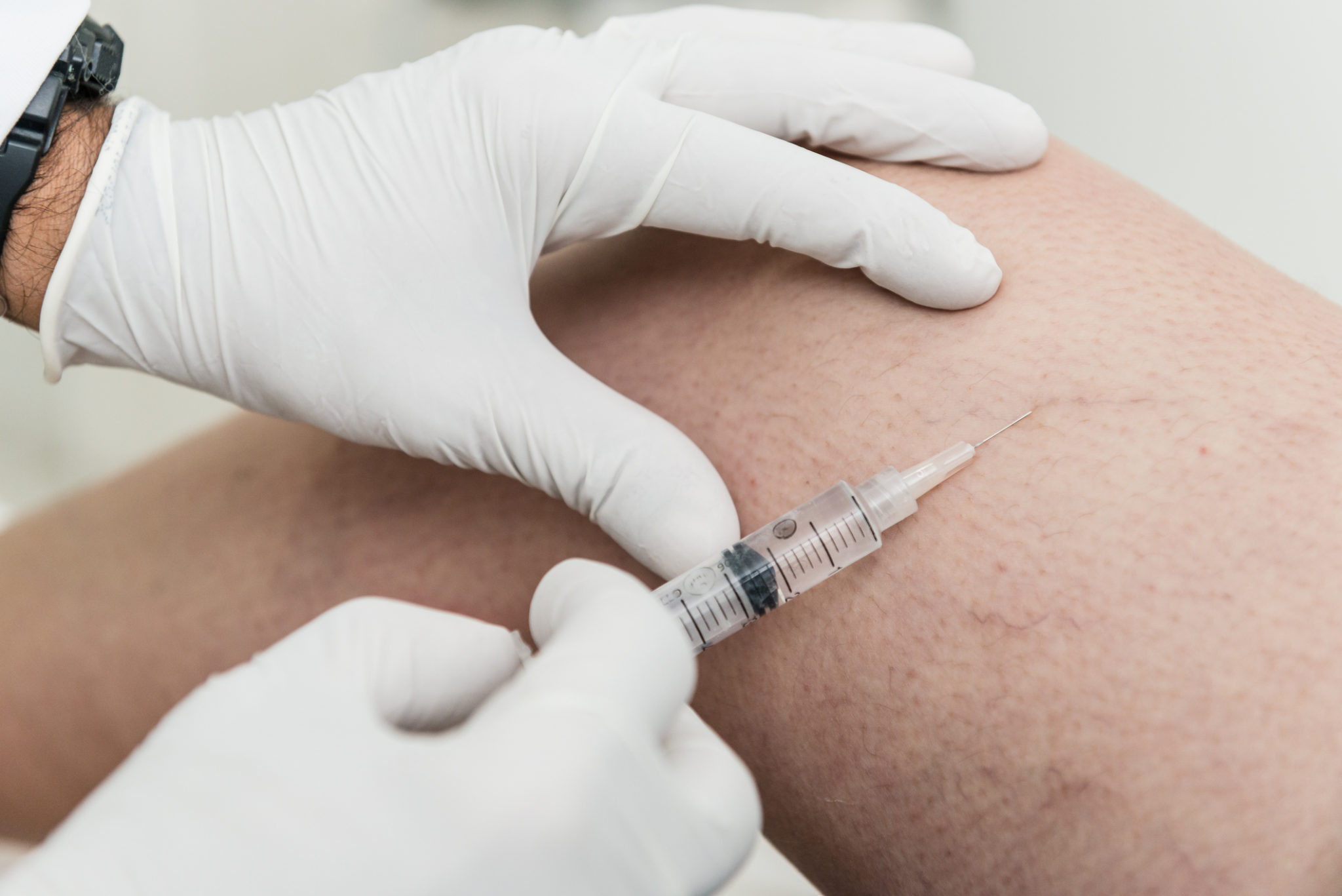 Varicose Veins Topical Surgical Minimally Invasive Treatment Options