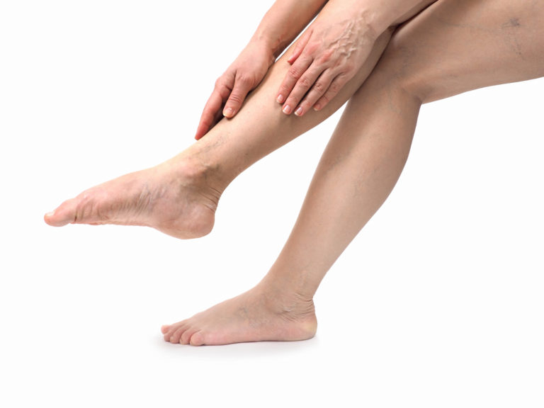Recognizing and Healing Venous Stasis Ulcers | Vegas Valley Vein